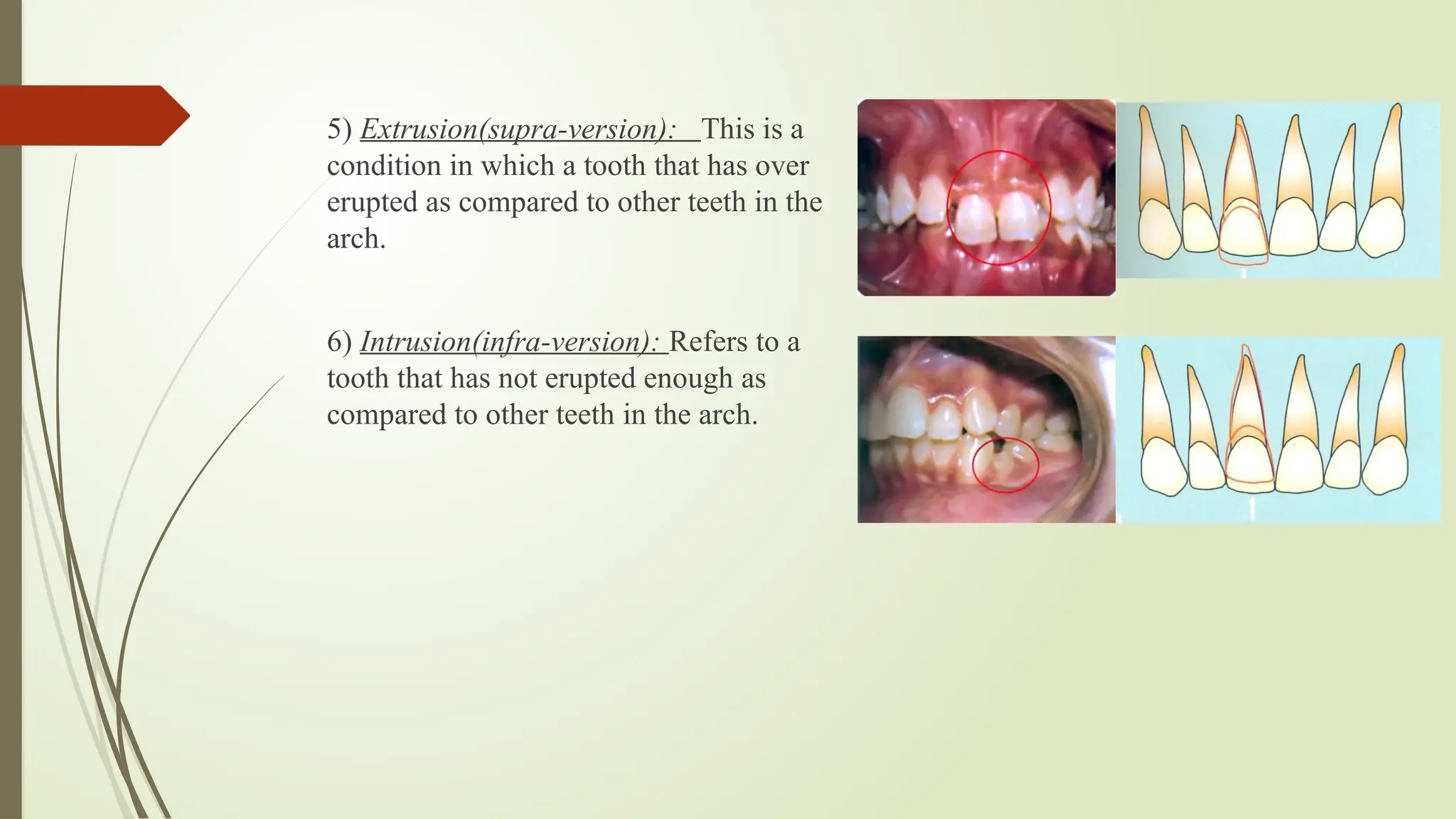 CLASSIFICATION OF MALOCCLUSION in orthodontics | PPTX