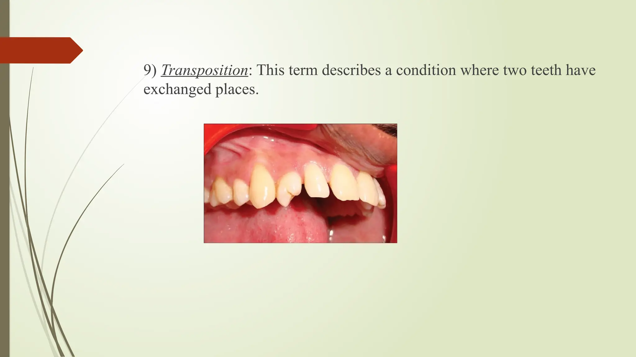 CLASSIFICATION OF MALOCCLUSION in orthodontics | PPTX