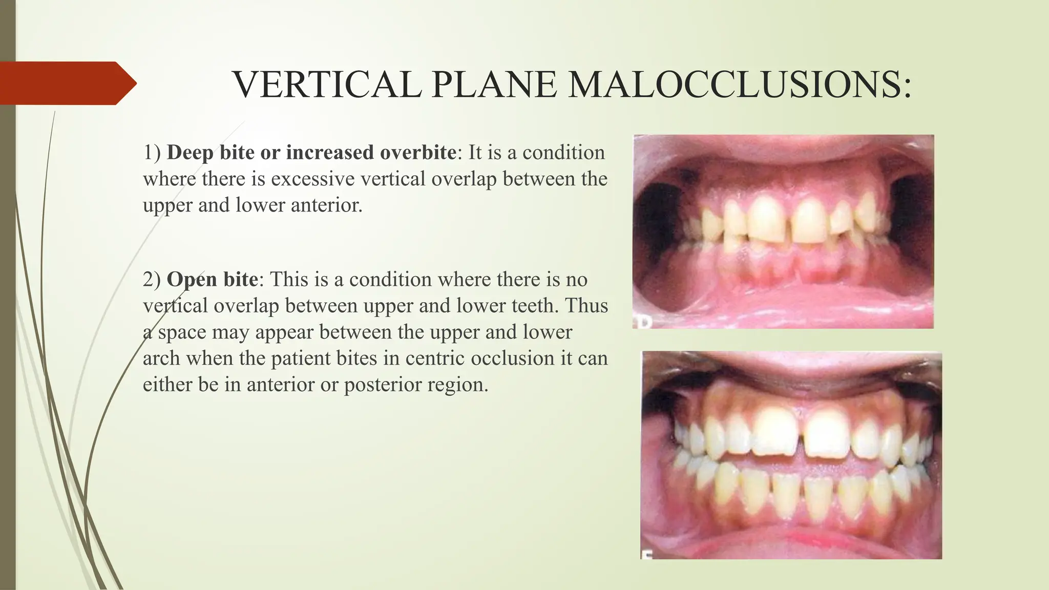 CLASSIFICATION OF MALOCCLUSION in orthodontics | PPTX