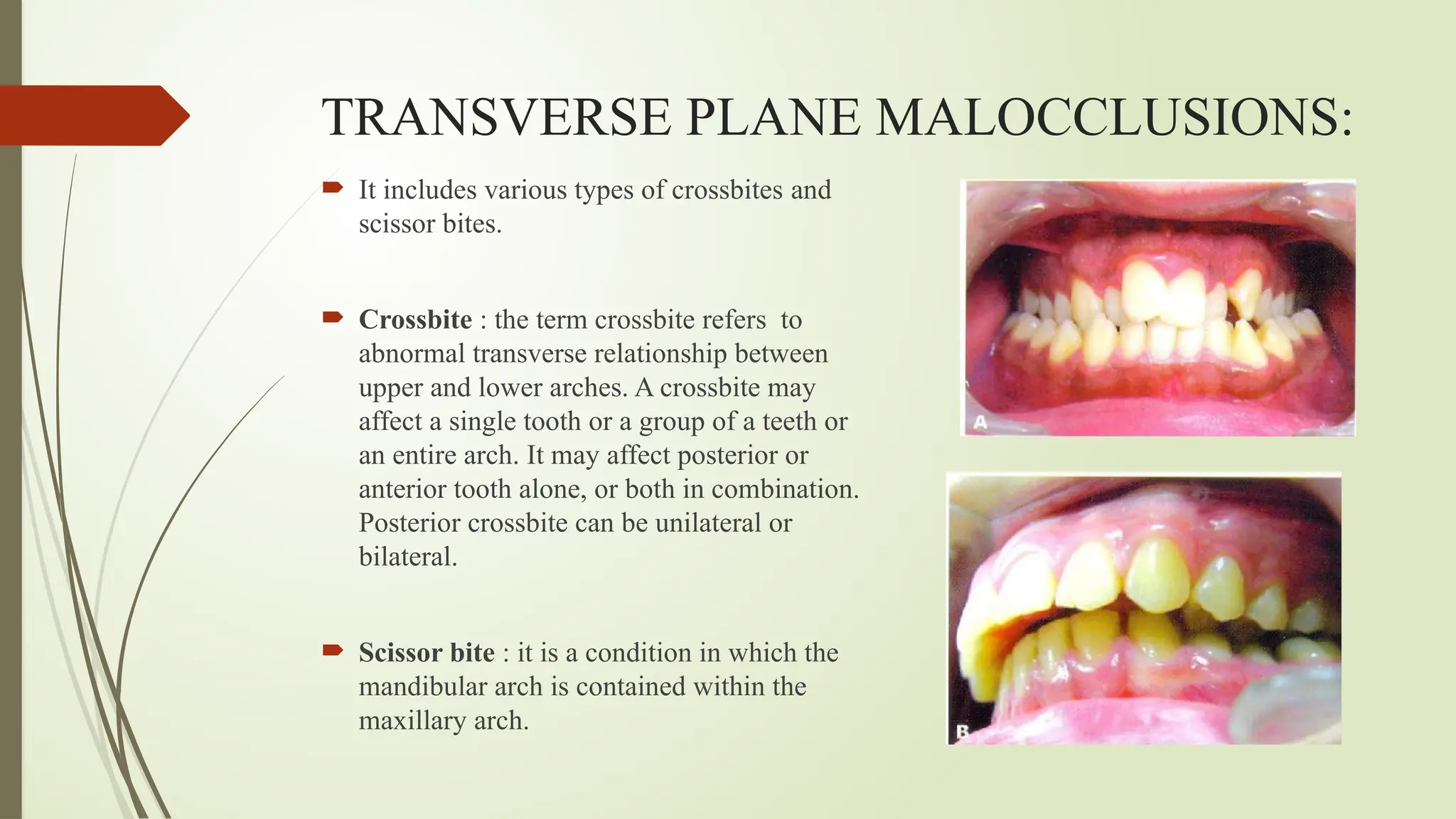 CLASSIFICATION OF MALOCCLUSION in orthodontics | PPTX