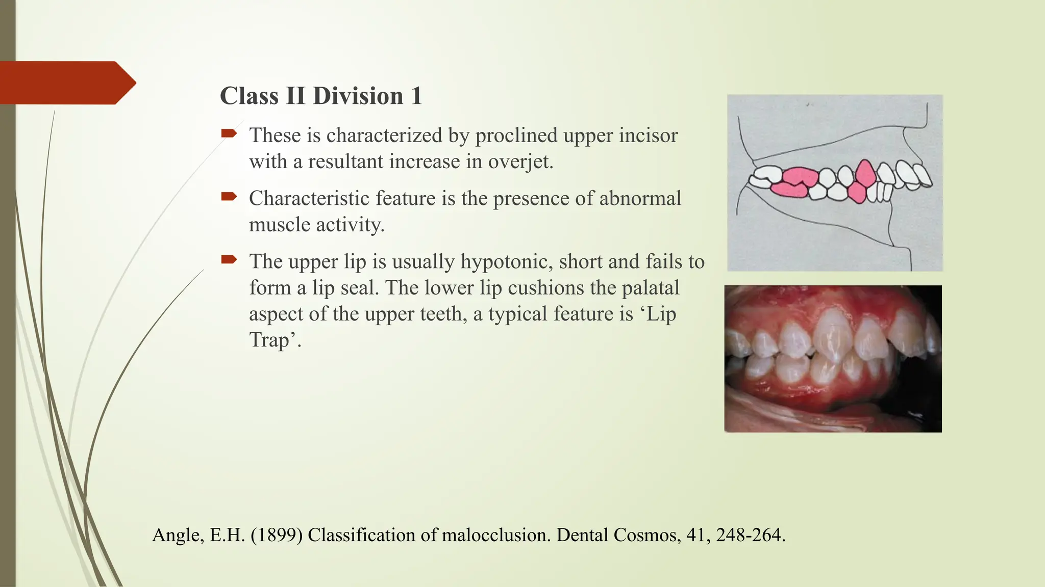 CLASSIFICATION OF MALOCCLUSION in orthodontics | PPTX