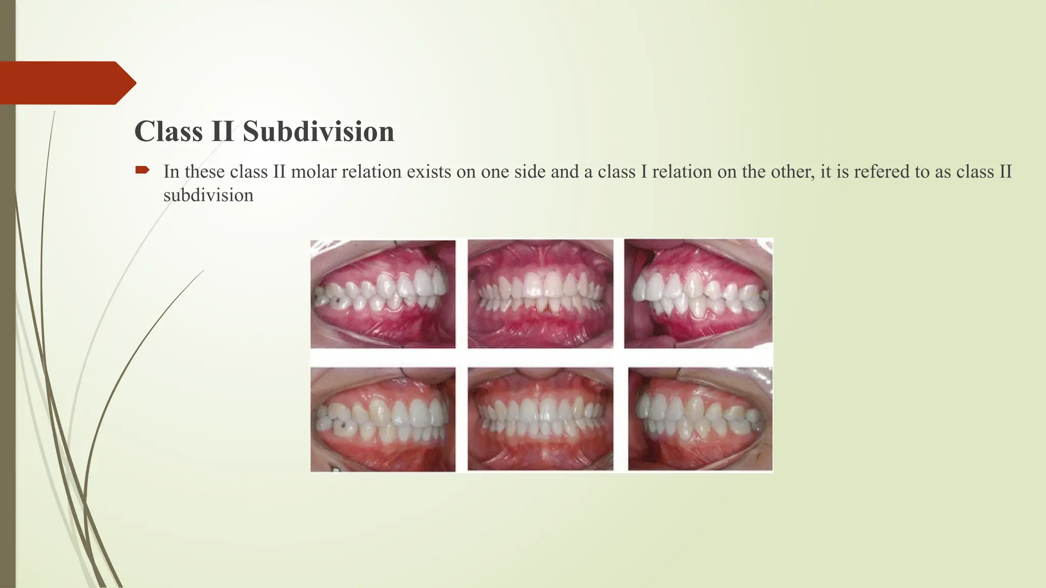 CLASSIFICATION OF MALOCCLUSION in orthodontics | PPTX