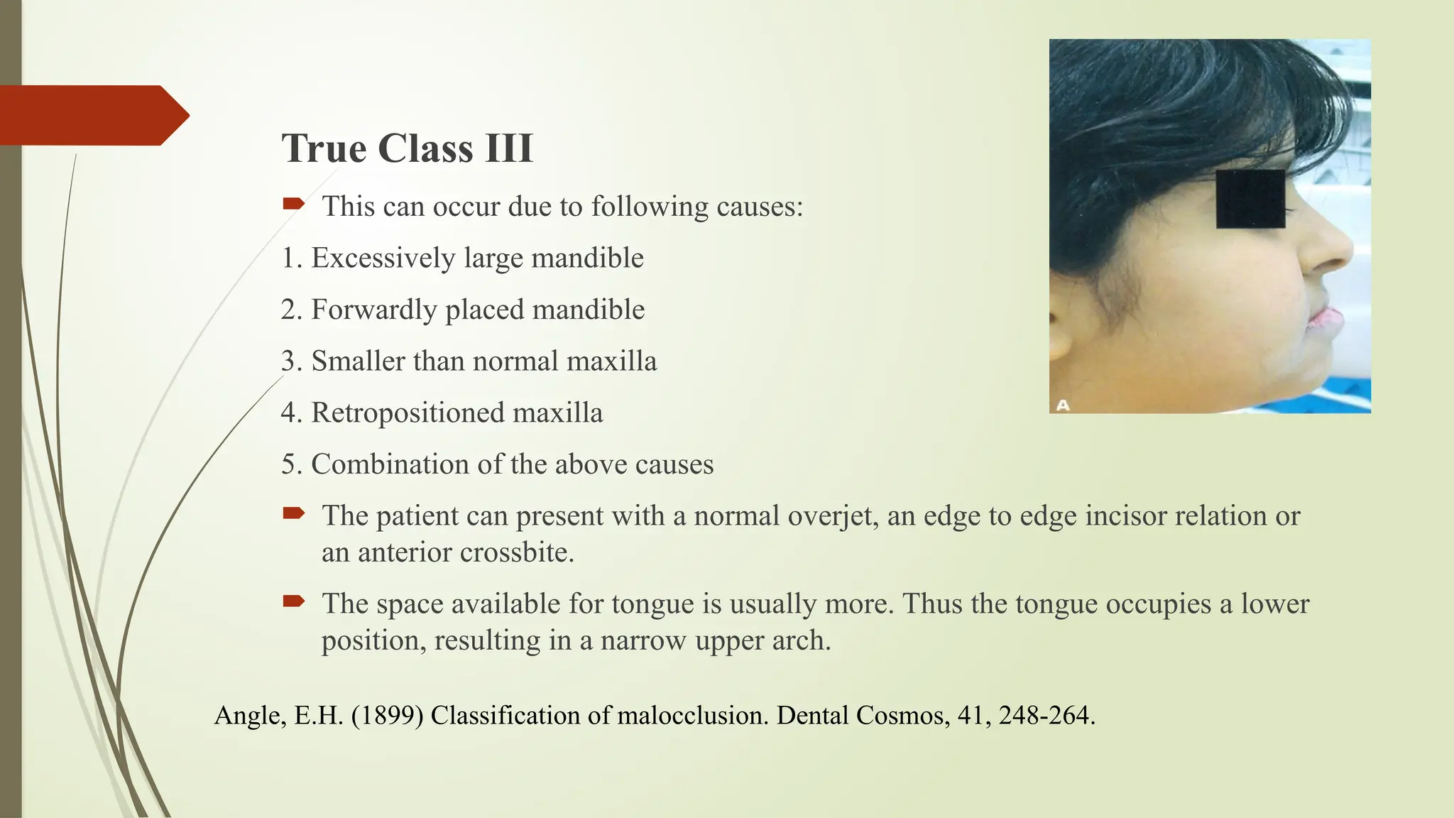 CLASSIFICATION OF MALOCCLUSION in orthodontics | PPTX