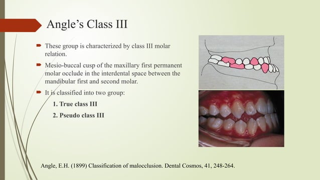 CLASSIFICATION OF MALOCCLUSION in orthodontics | PPTX