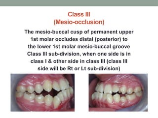 Classification of Maloccvbvvbblusion.pptx