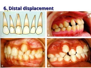 Classification of Malocclusion in orthodontics .ppt