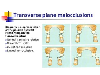 Classification of Malocclusion in orthodontics .ppt