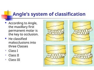Classification of Malocclusion in orthodontics .ppt