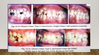 CLASSIFICATION OF MALOCCLUSION and deweys modifications .pptx