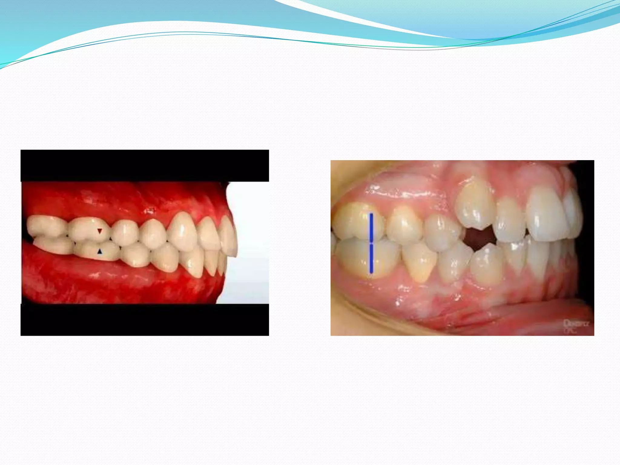Classification of malocclusion | PPTX