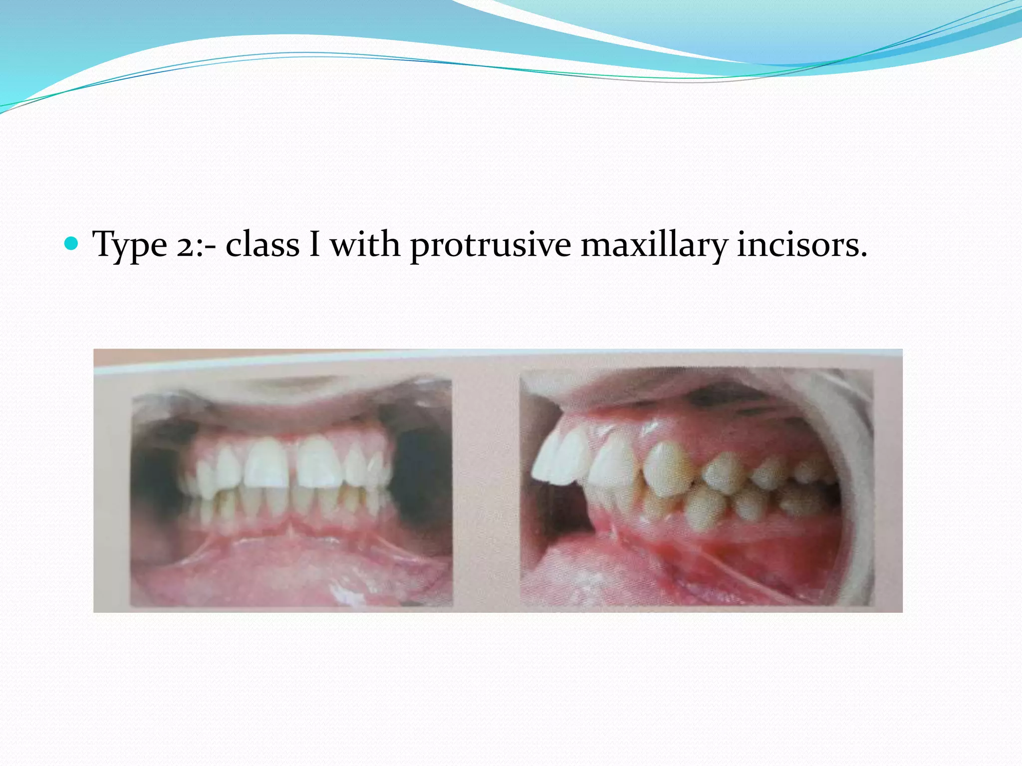Classification of malocclusion | PPTX