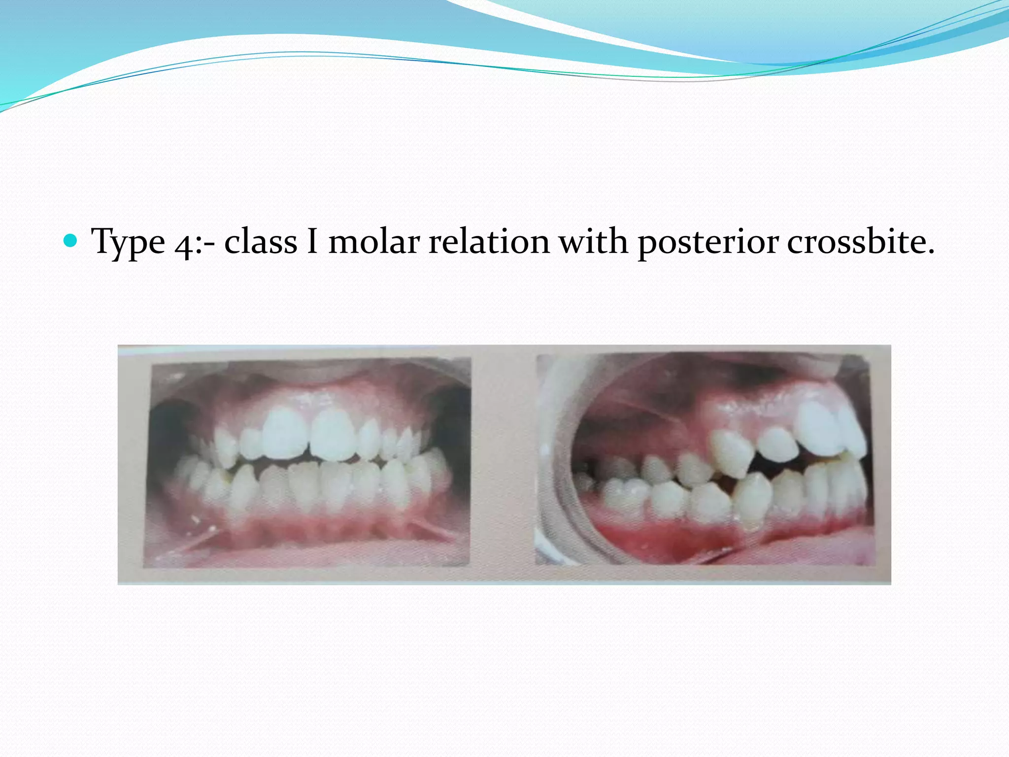 Classification of malocclusion | PPTX