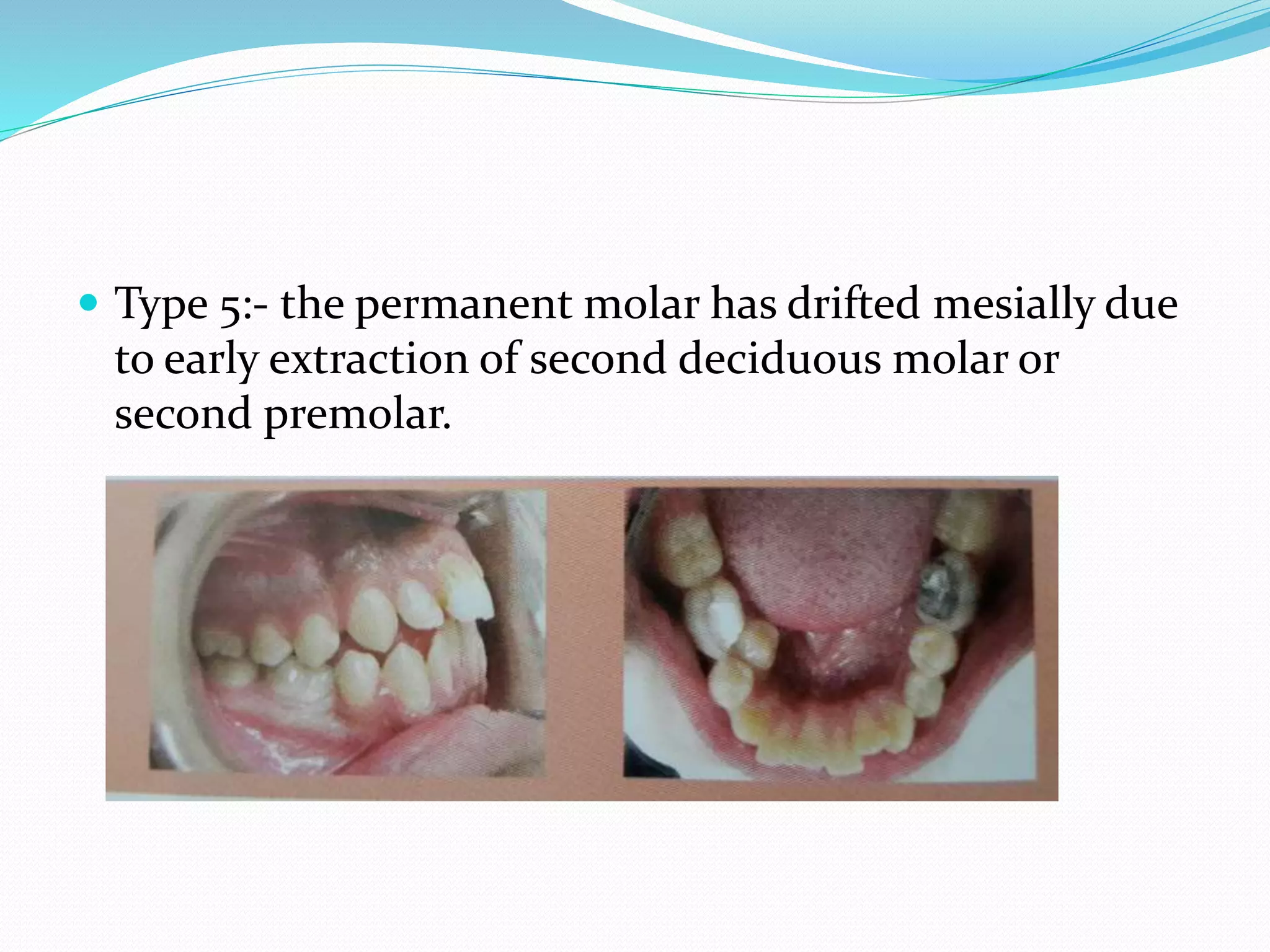 Classification of malocclusion | PPTX