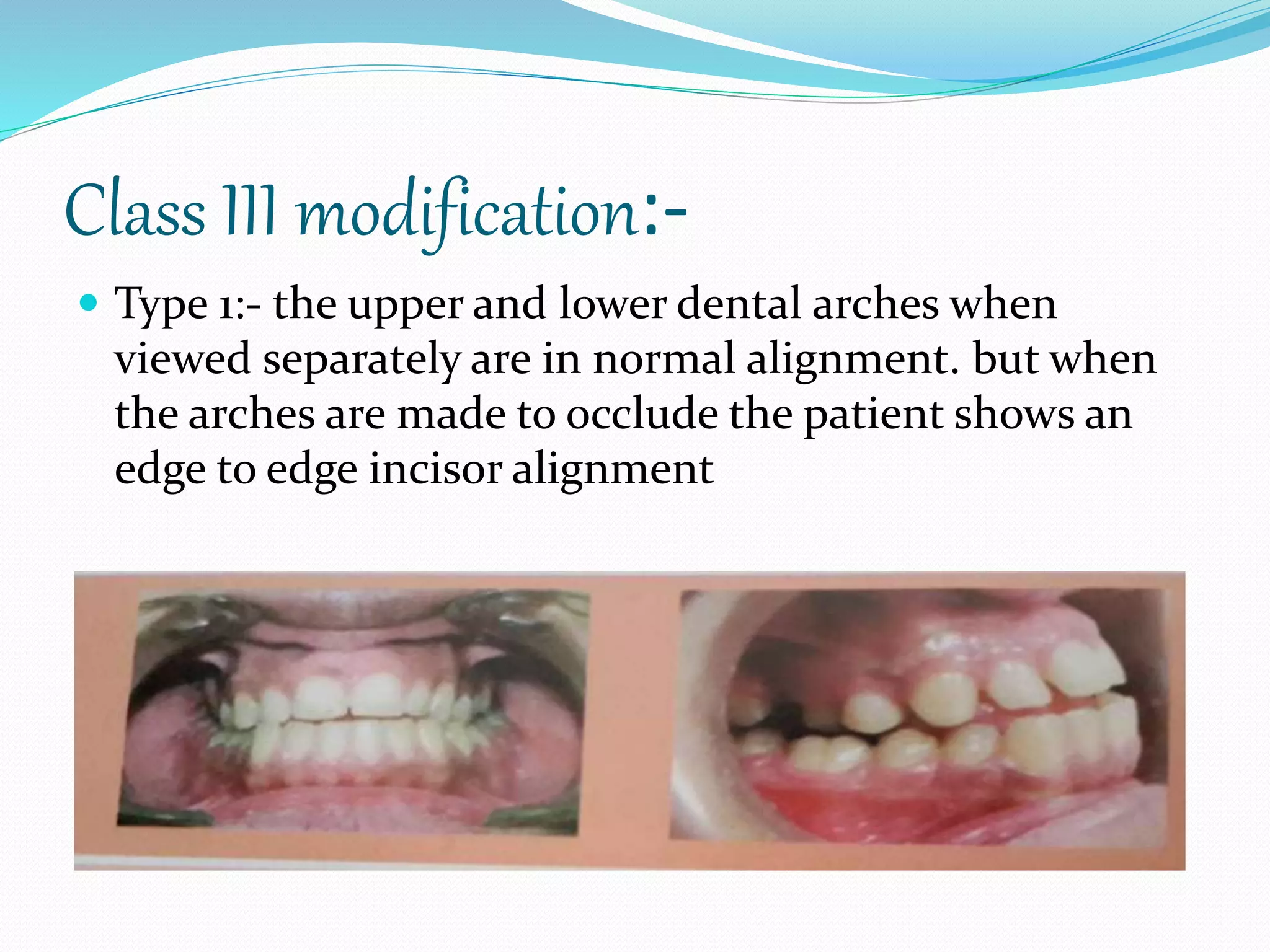 Classification of malocclusion | PPTX