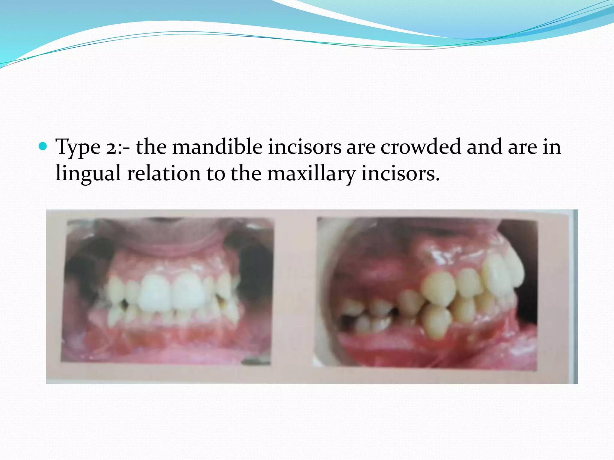 Classification of malocclusion | PPTX