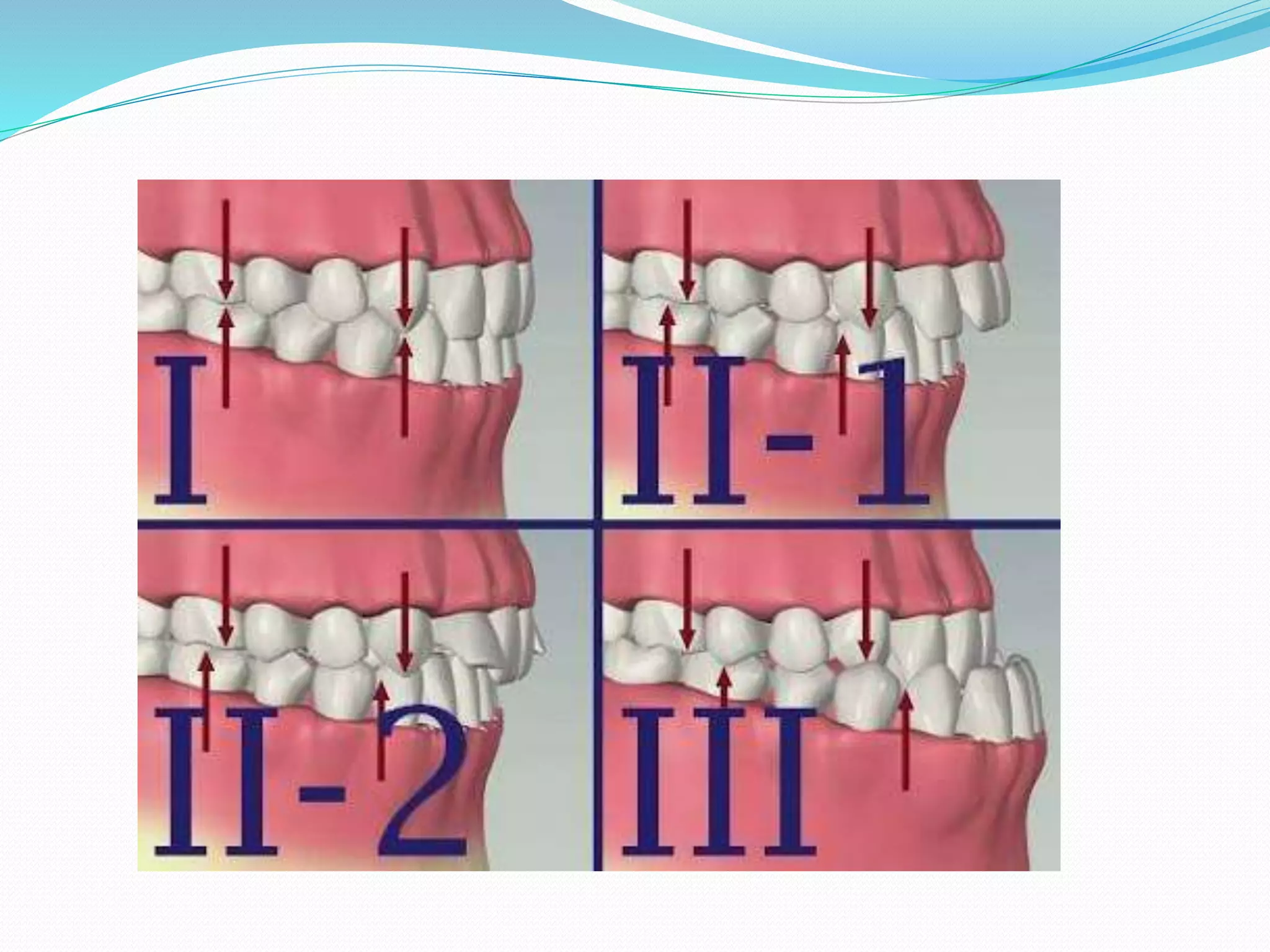 Classification of malocclusion | PPTX