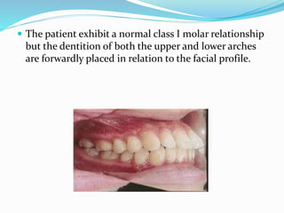 Classification of malocclusion | PPTX