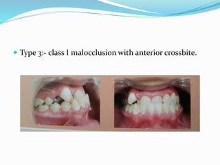 Classification of malocclusion | PPTX