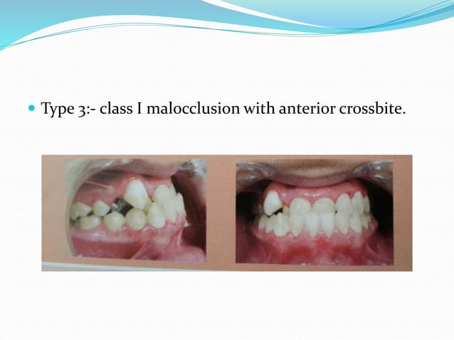 Classification of malocclusion | PPTX
