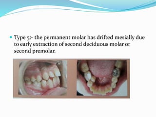 Classification of malocclusion | PPTX