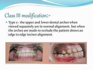 Classification of malocclusion | PPTX