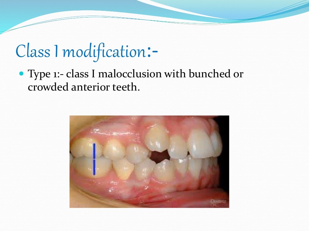 Classification of malocclusion