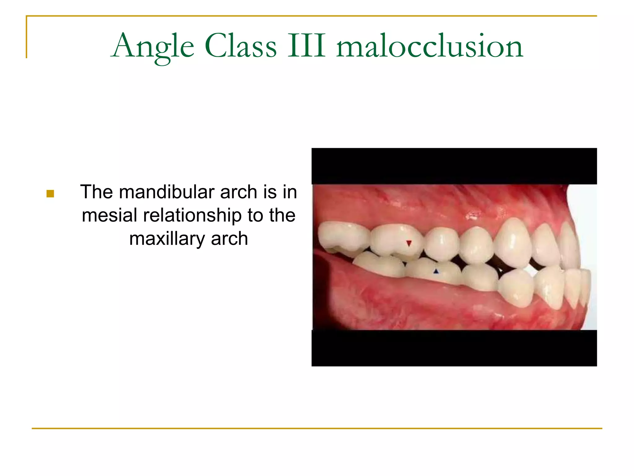 Classification of malocclusion-converted (1).pdf