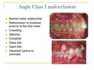 Classification of malocclusion-converted (1).pdf