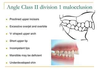 Classification of malocclusion-converted (1).pdf