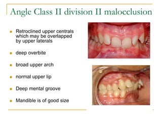 Classification of malocclusion-converted (1).pdf