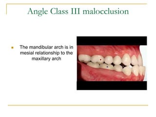 Classification of malocclusion-converted (1).pdf