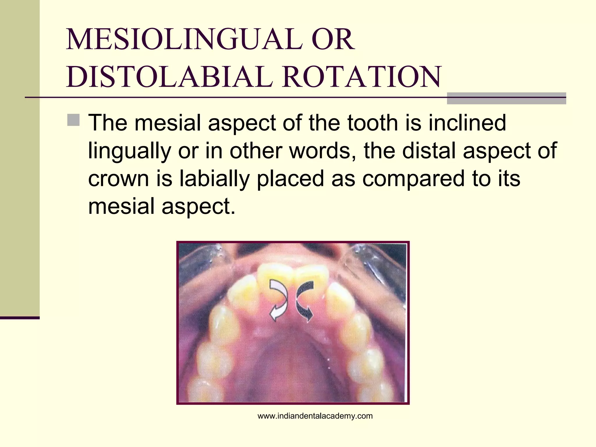 Classification of malocclusion | PPT