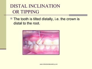 Classification of malocclusion | PPT