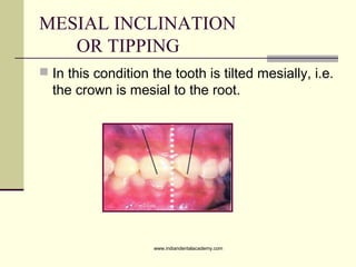 Classification of malocclusion1 | PPT