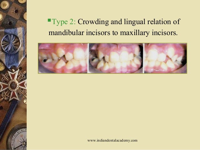 Classification of malocclusion1