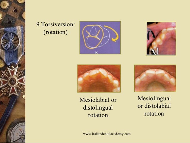 Classification of malocclusion1