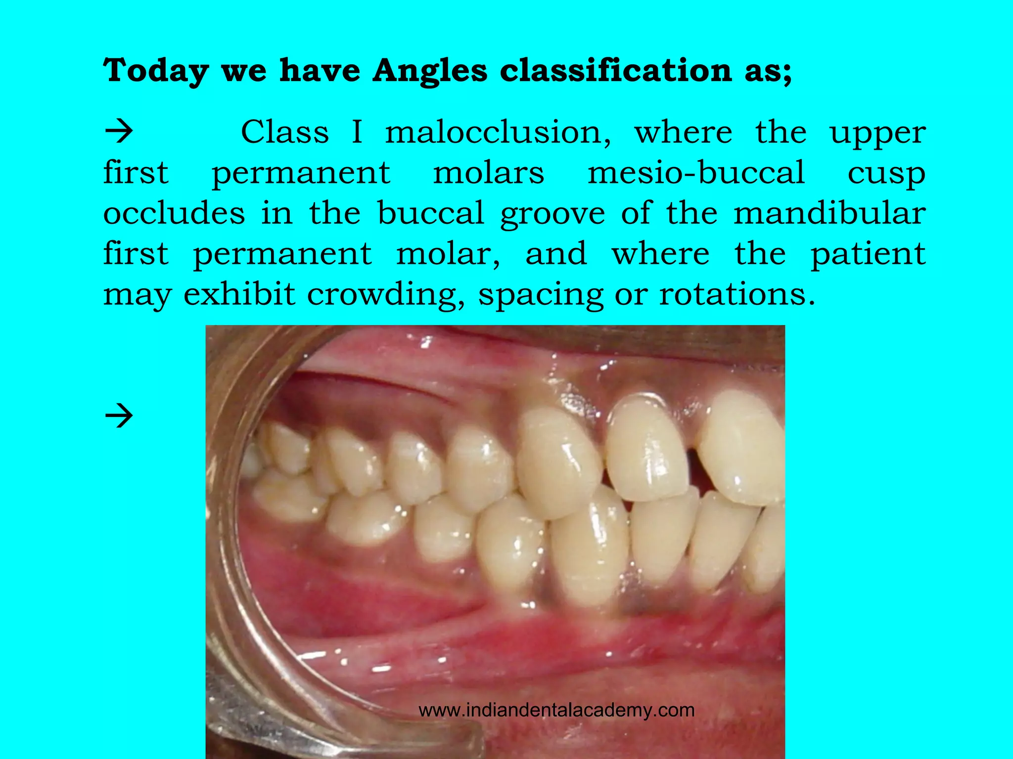 Classification of malocclusion (4) | PPT