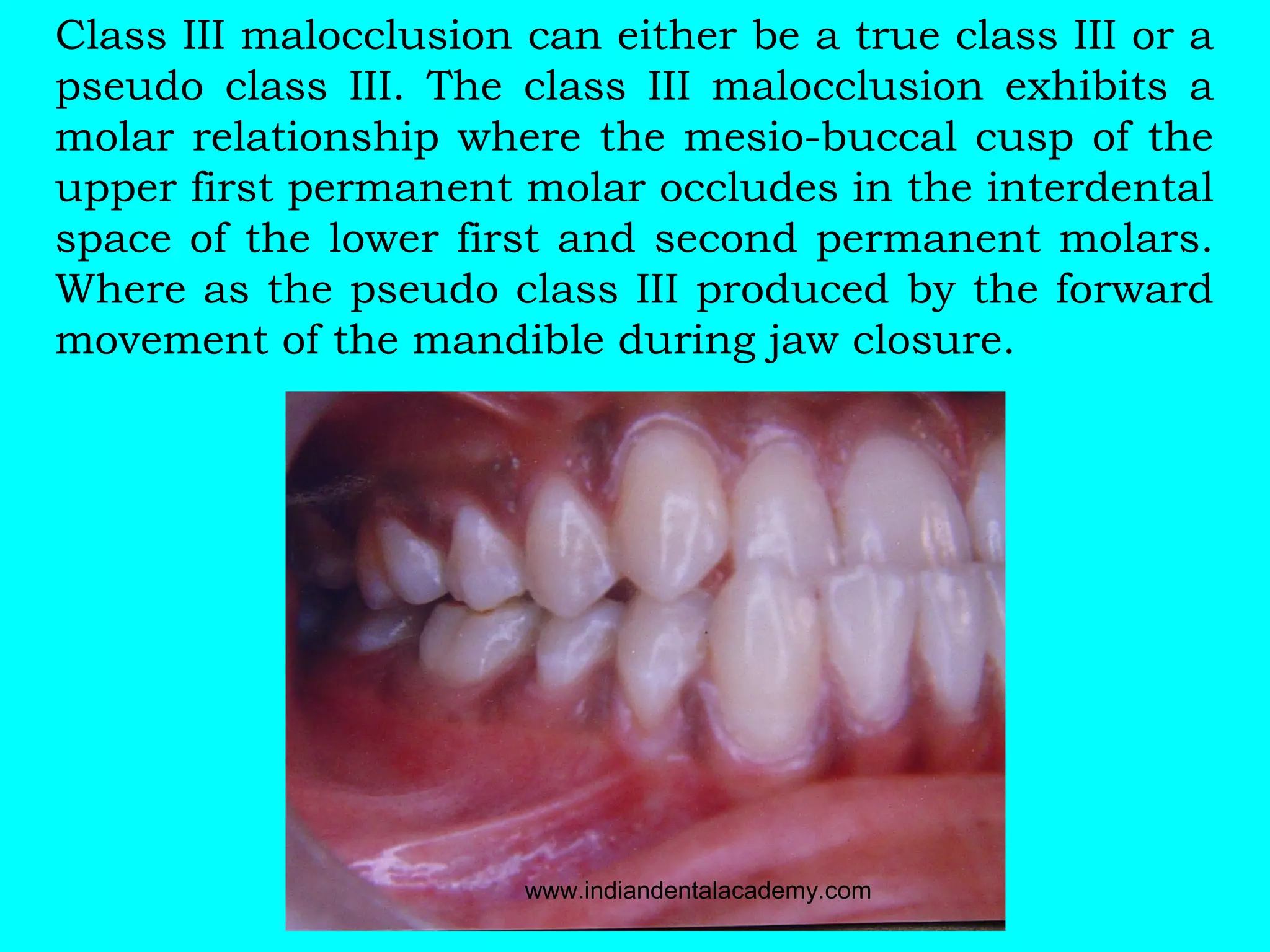 Classification of malocclusion (4) | PPT