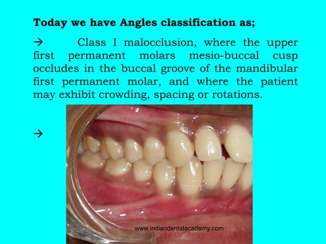 Classification of malocclusion (4)