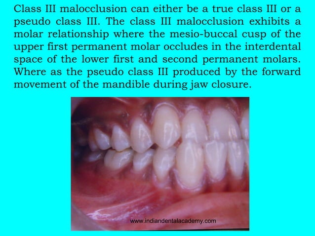 Classification of malocclusion (4)