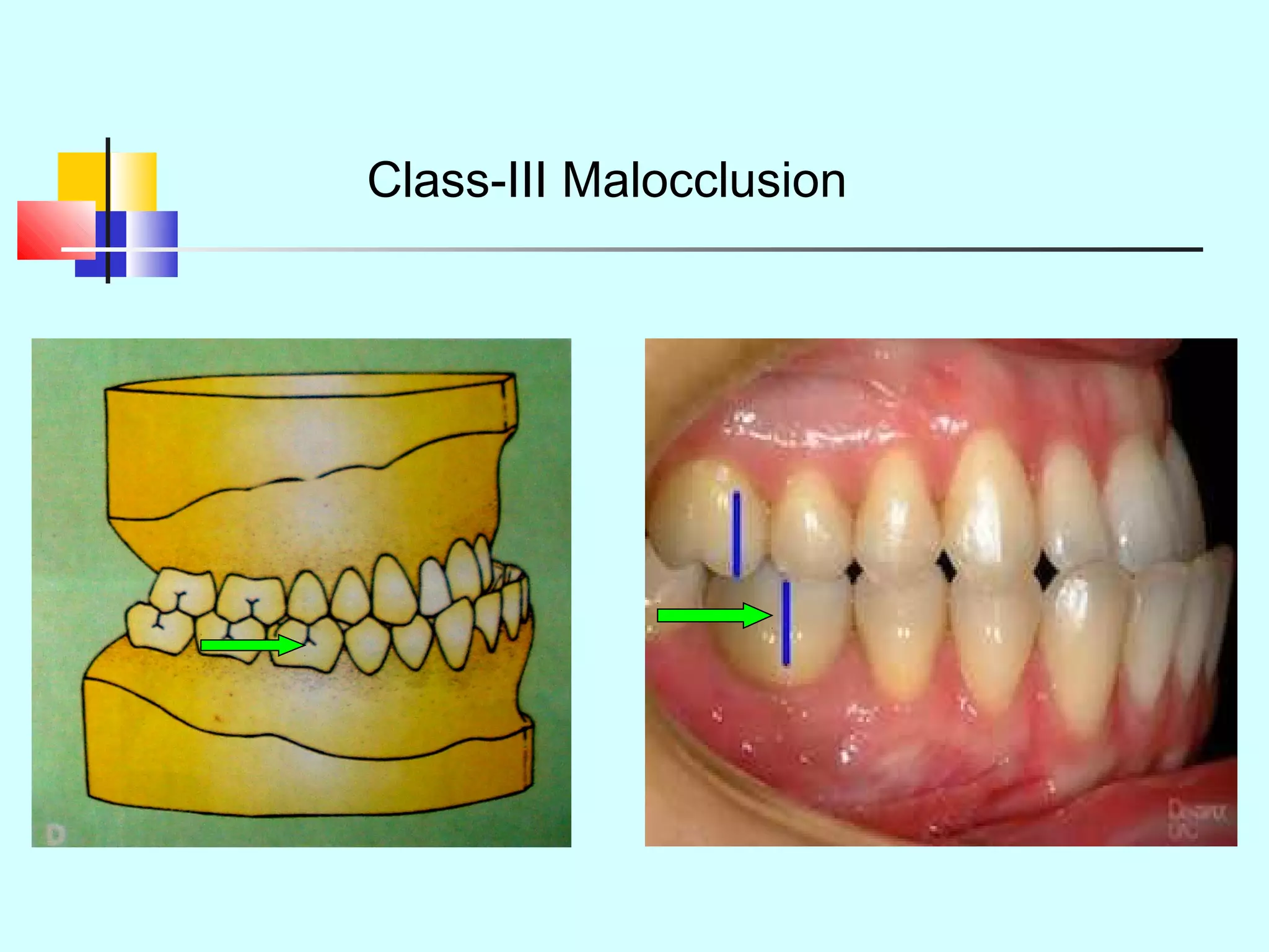 Classification of malocclusion by dr. golam | PPT