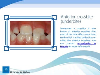 Classification of Malocclusion in Orthodontics | PPT