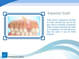 Classification of Malocclusion in Orthodontics | PPT