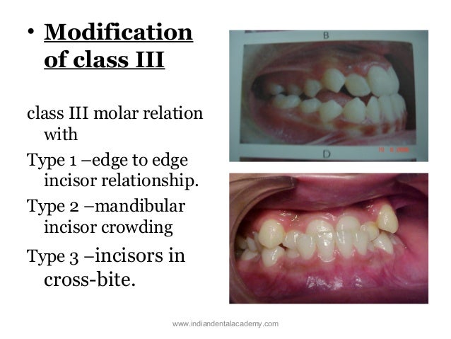 Classification of malocclusion /certified fixed orthodontic courses