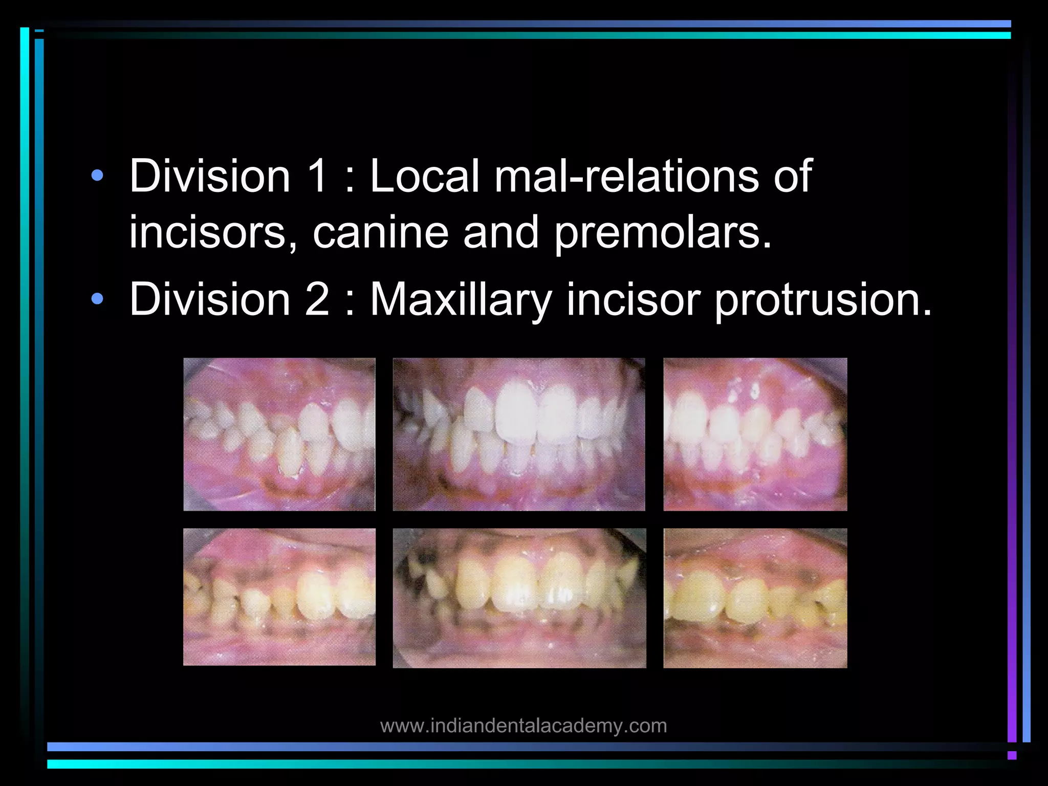 Classification of maloclusion2 | PPT