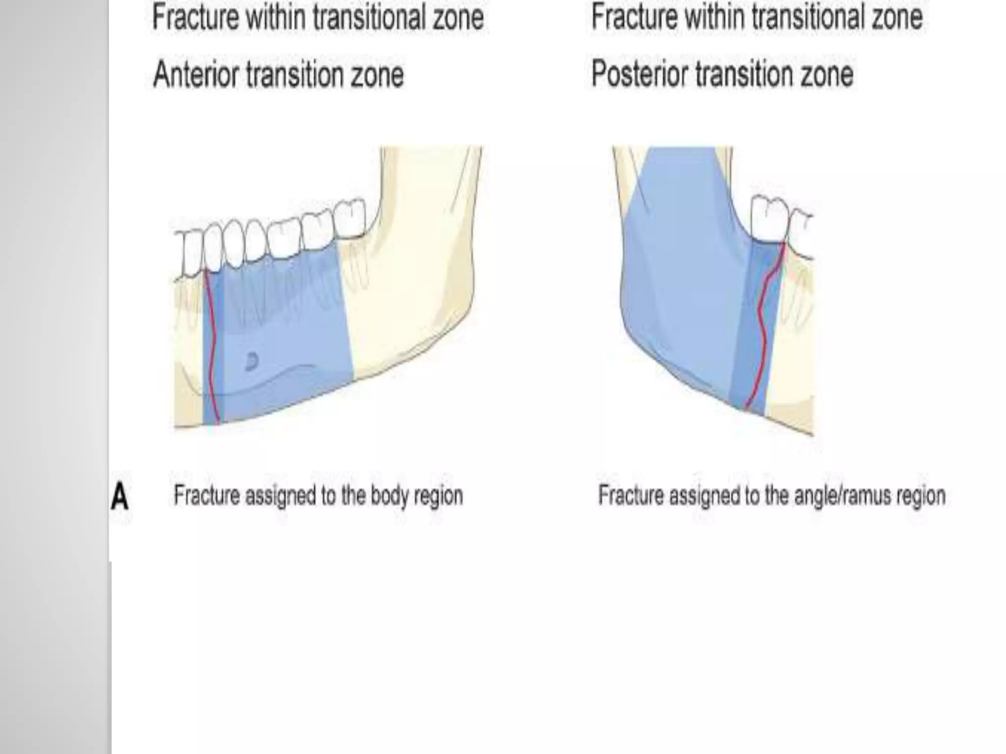 Classification of mandible fracture | PPTX