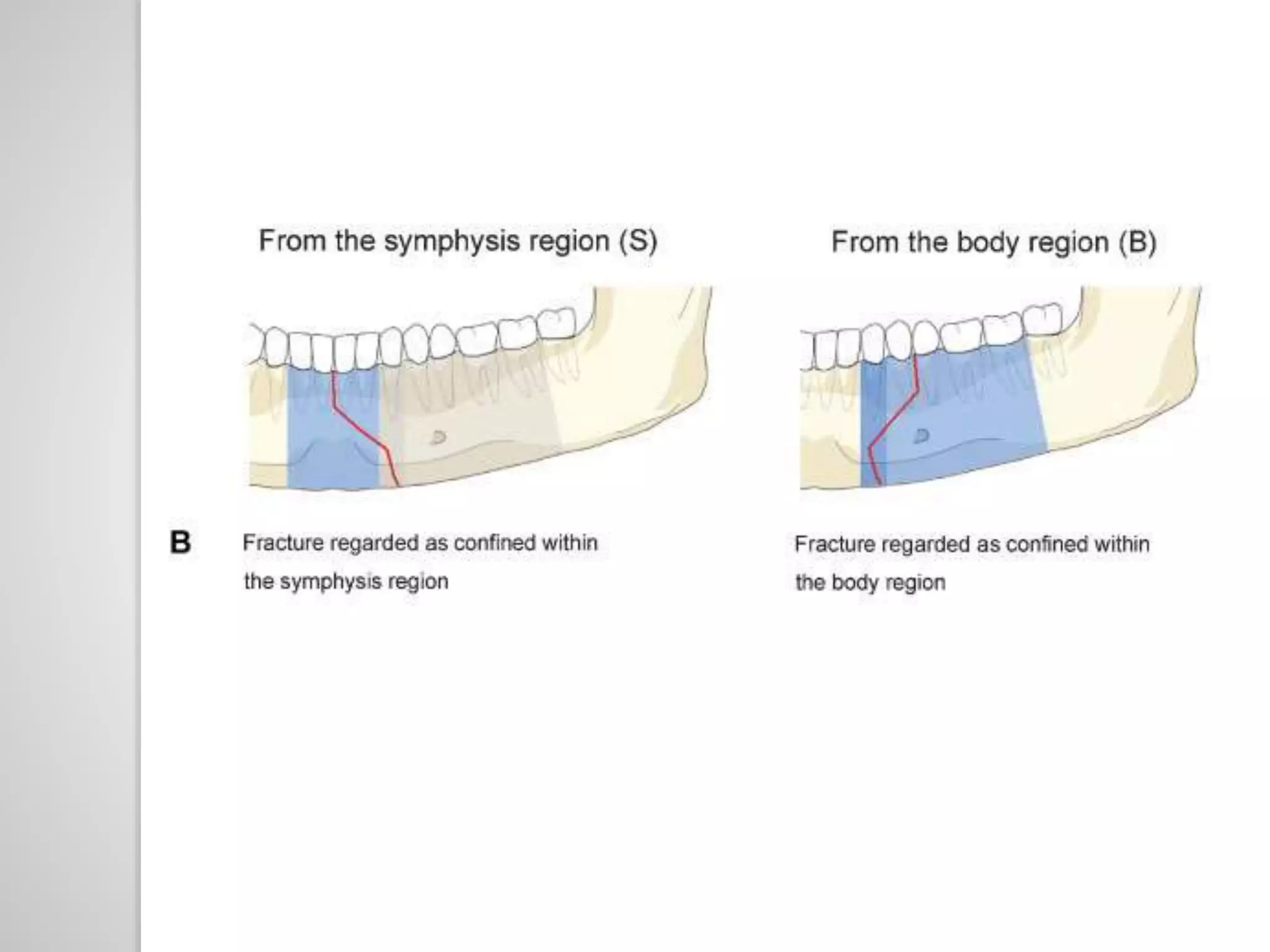 Classification of mandible fracture | PPTX
