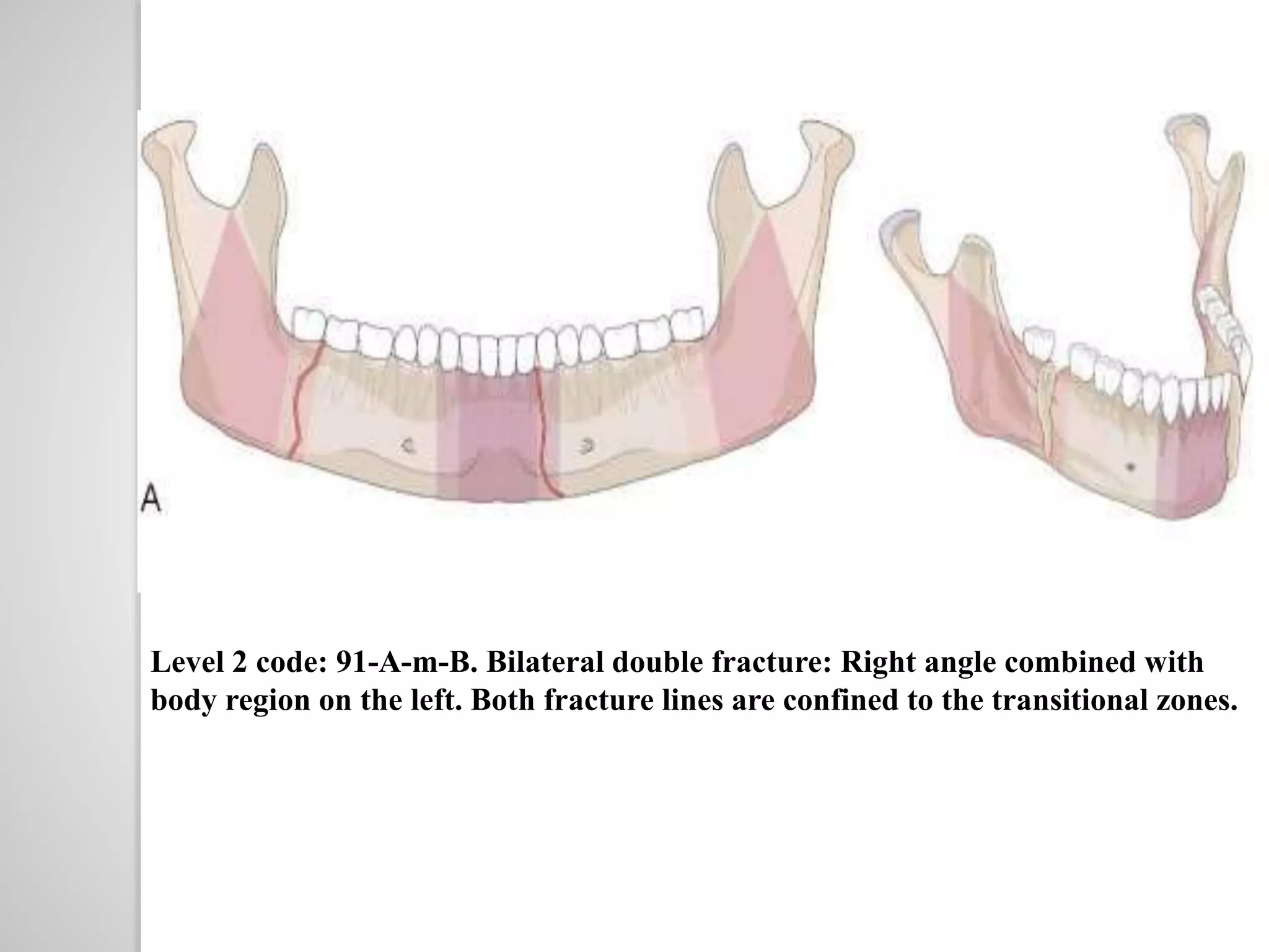 Classification of mandible fracture | PPTX