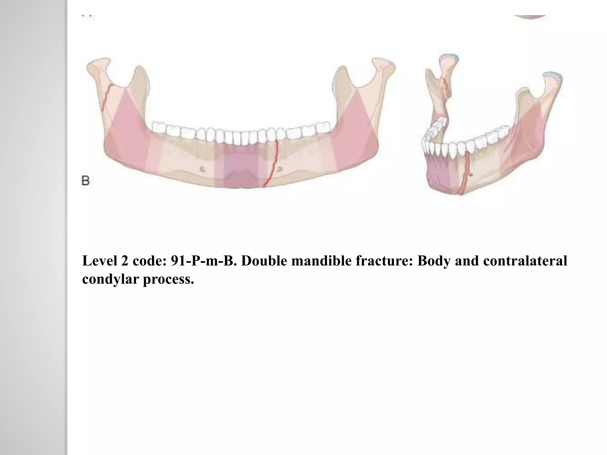 Classification of mandible fracture | PPTX