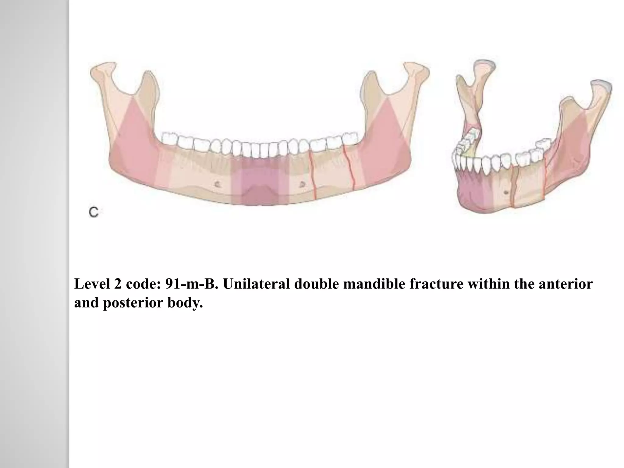 Classification of mandible fracture | PPTX